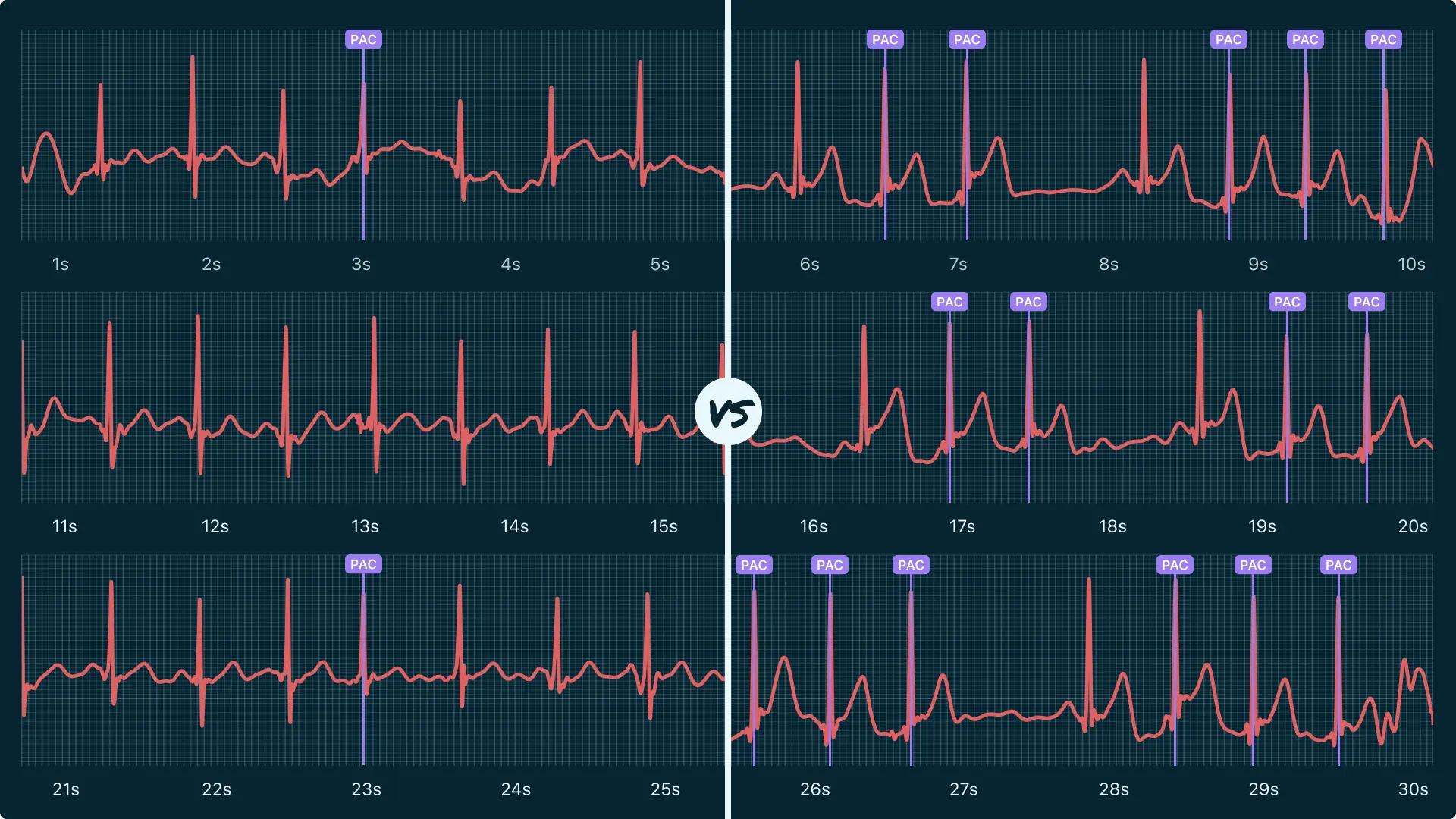 Premature Atrial Contraction (Multiple) Vs. Supraventricular Tachycardia (Non-Sustained) on Your ...